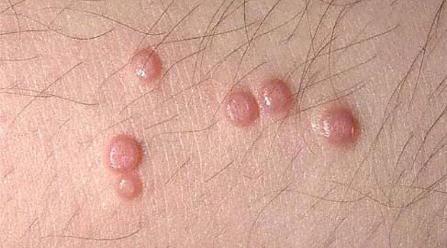 Ngứa và nổi sần ở vùng kín có phải sùi mào gà không?