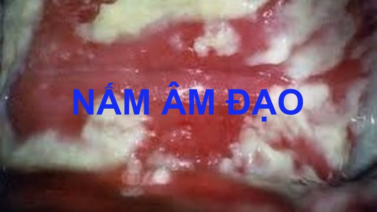 Đang bị nấm âm đạo + viêm lộ tuyến cấp 1 có quan hệ được không?