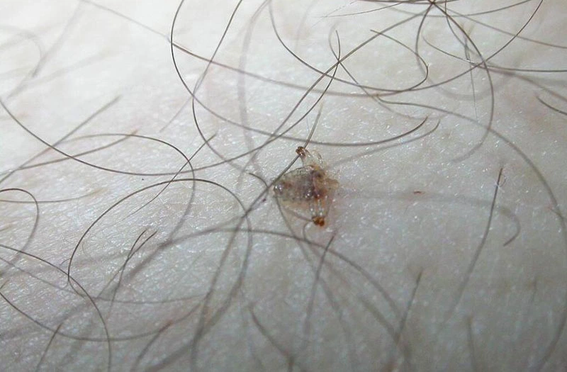 Phần lông mu bị ngứa là tại sao?