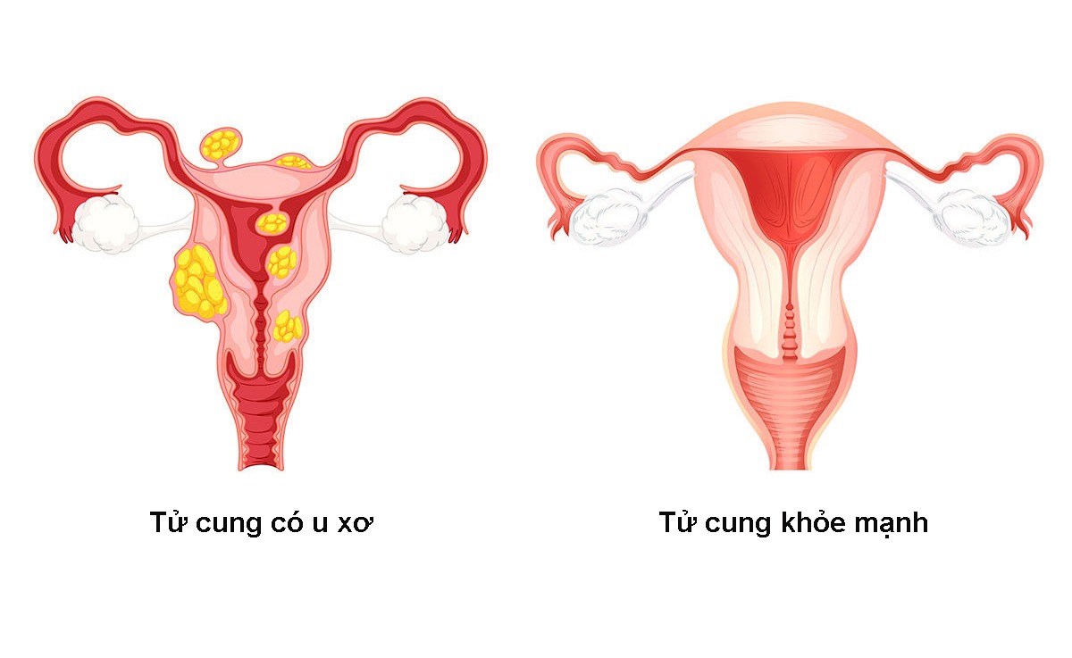 Phát hiện u xơ tử cung sau khi vừa hút thai