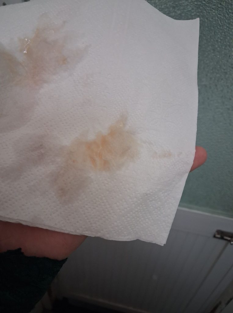 Ra khí hư nâu sau kì kinh nguyệt có phải do sinh mổ làm cổ tử cung mỏng ...